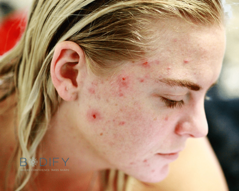How Does Morpheus8 Treat Uneven Skin Texture Caused by Old Acne Scars ...